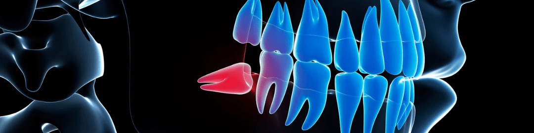 Dente Siso: O Que é E Quando Extrair?